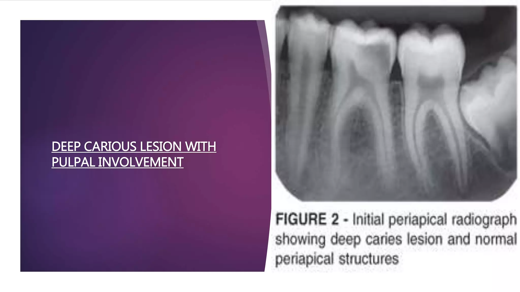 Direct and Indirect pulp capping | PPTX