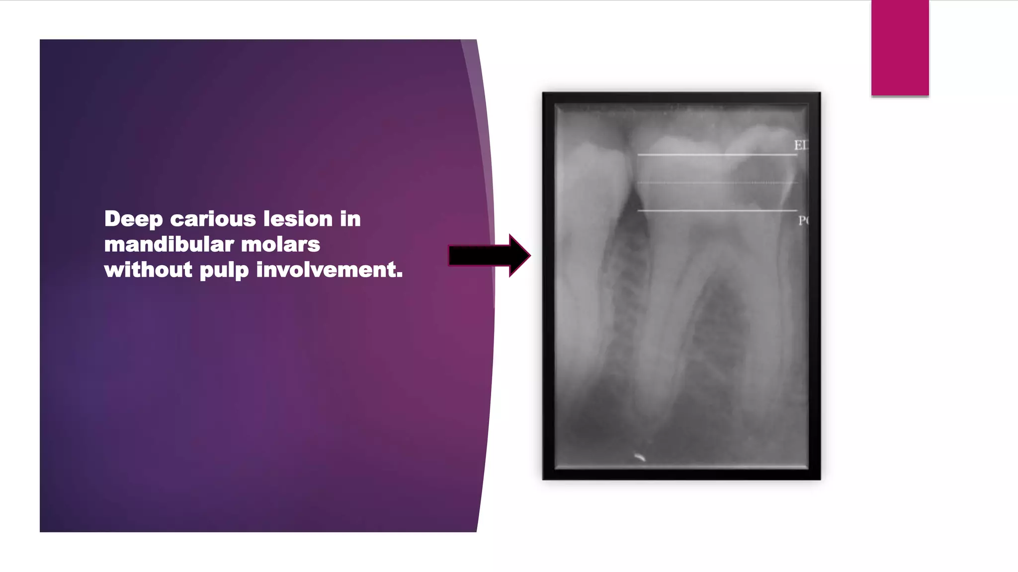Direct and Indirect pulp capping | PPTX