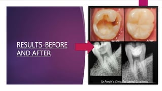 Direct and Indirect pulp capping | PPTX