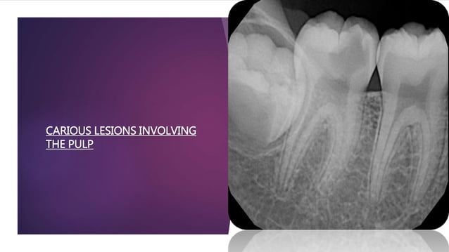 Direct and Indirect pulp capping | PPTX