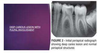 Direct and Indirect pulp capping | PPTX