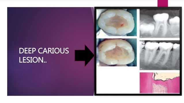 Direct and Indirect pulp capping | PPT