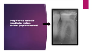 Direct and Indirect pulp capping | PPTX