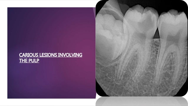 Direct and Indirect pulp capping