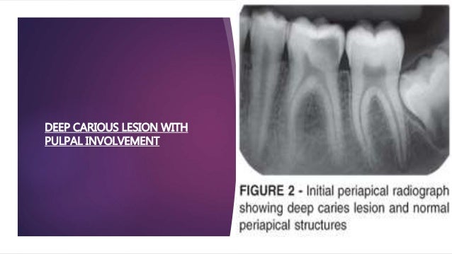 Direct and Indirect pulp capping