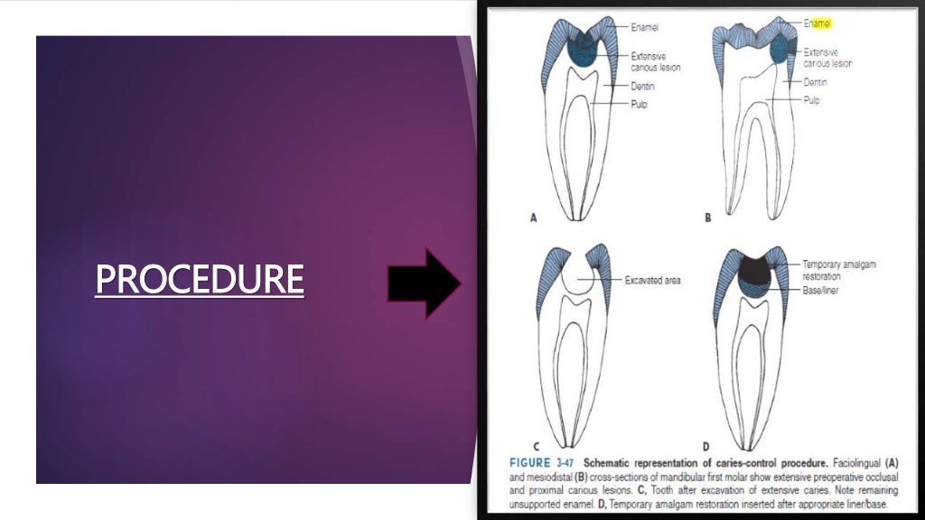 Indirect Pulp Capping Procedure Vrogue Co - vrogue.co