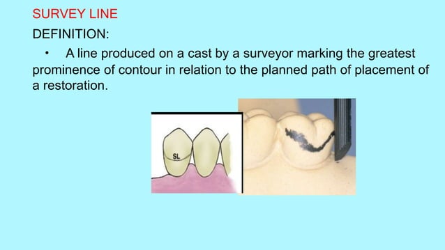 Direct and indirect retainers | PPTX | Oral care | Personal Care