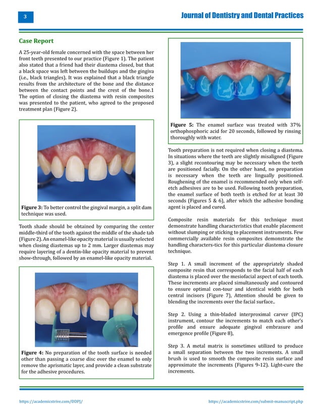 Direct Bonding in Diastema Closure High Drama, Immediate Resolution | PDF