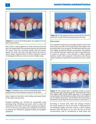 Direct Bonding in Diastema Closure High Drama, Immediate Resolution | PDF