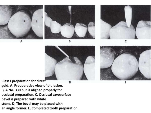 Direct gold restoration | PPTX | Dental Health | Diseases and Conditions