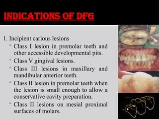 direct gold restoration classification uses and types | PPTX