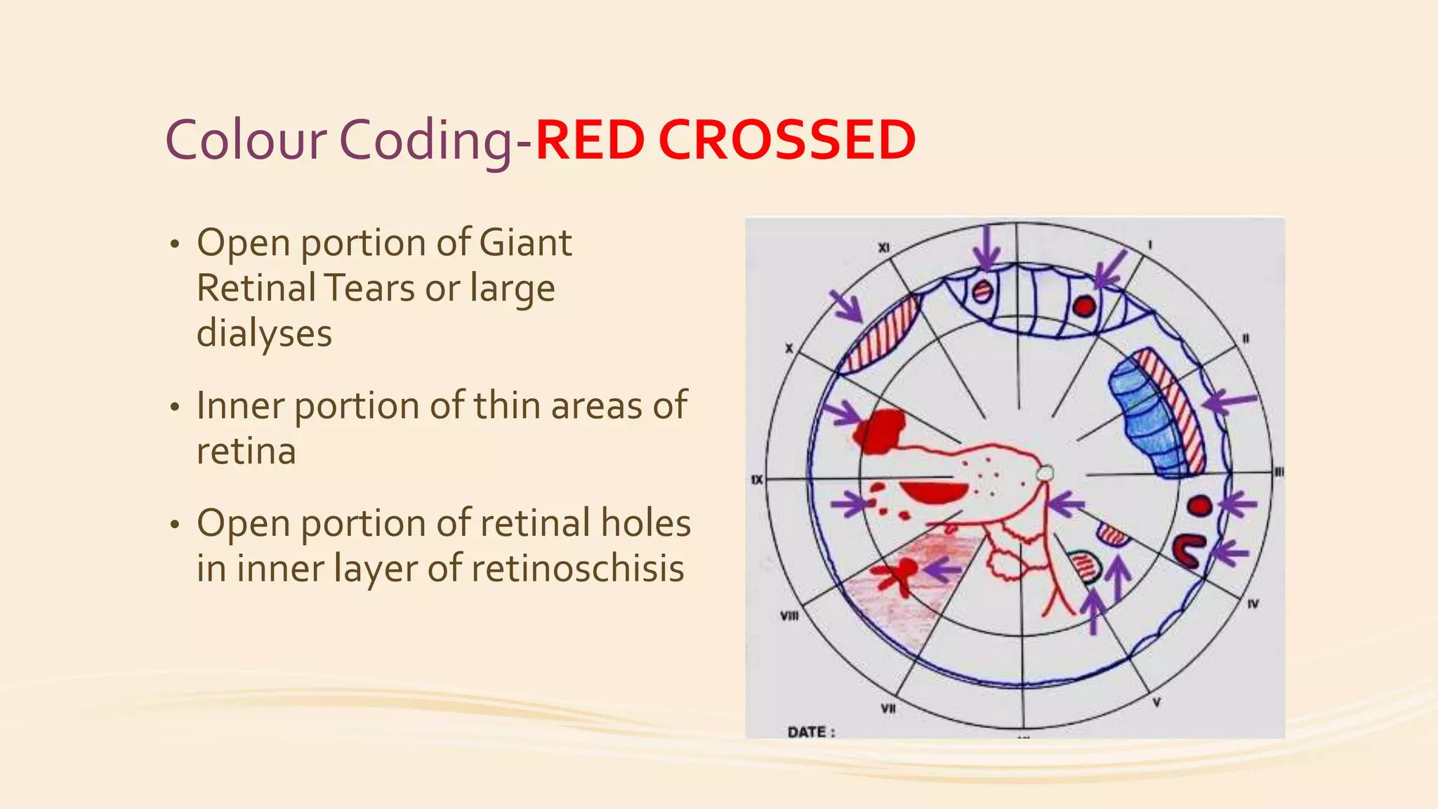 Direct & indirect ophthalmoscopy | PPTX