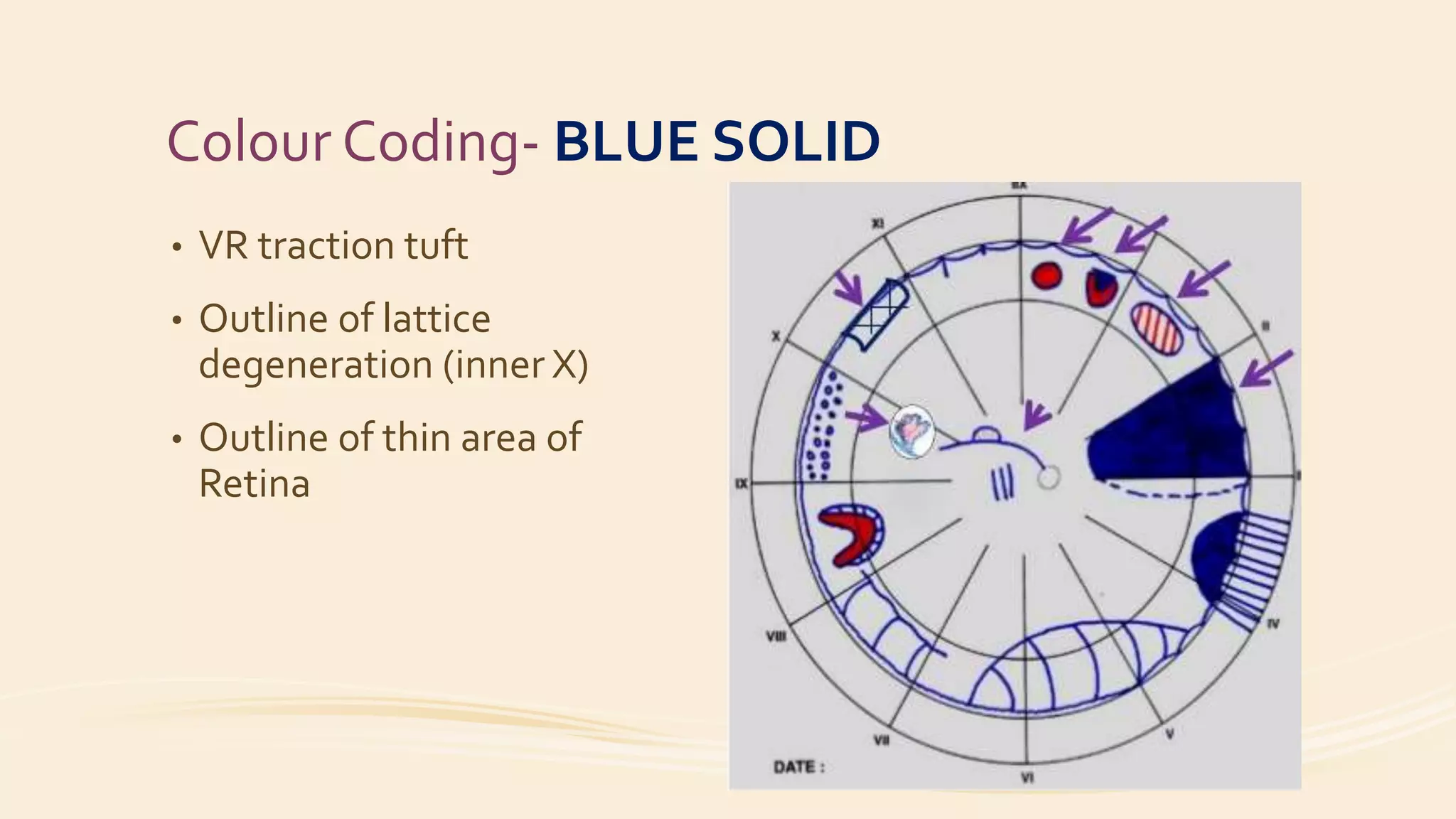 Direct & indirect ophthalmoscopy | PPTX