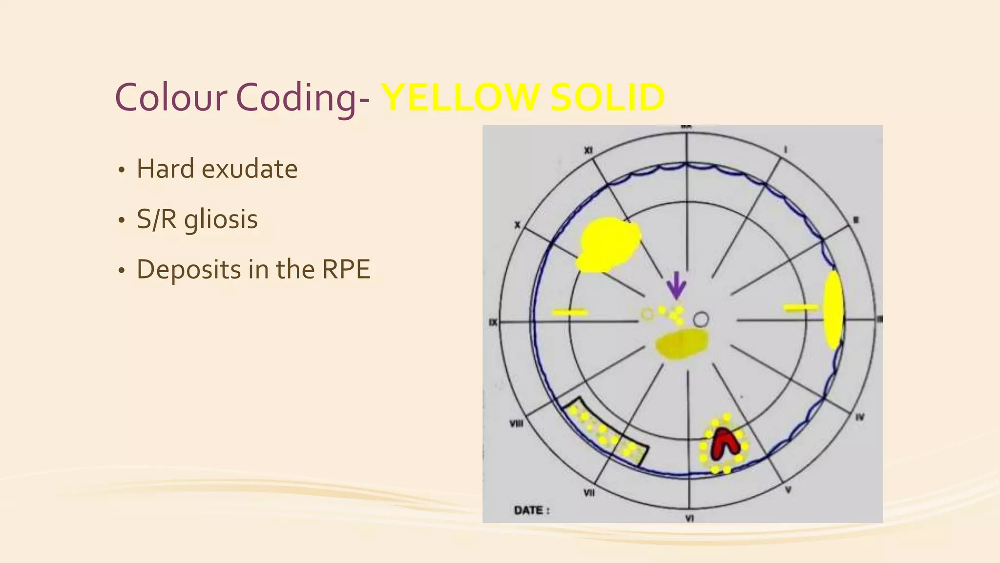 Direct & indirect ophthalmoscopy | PPTX