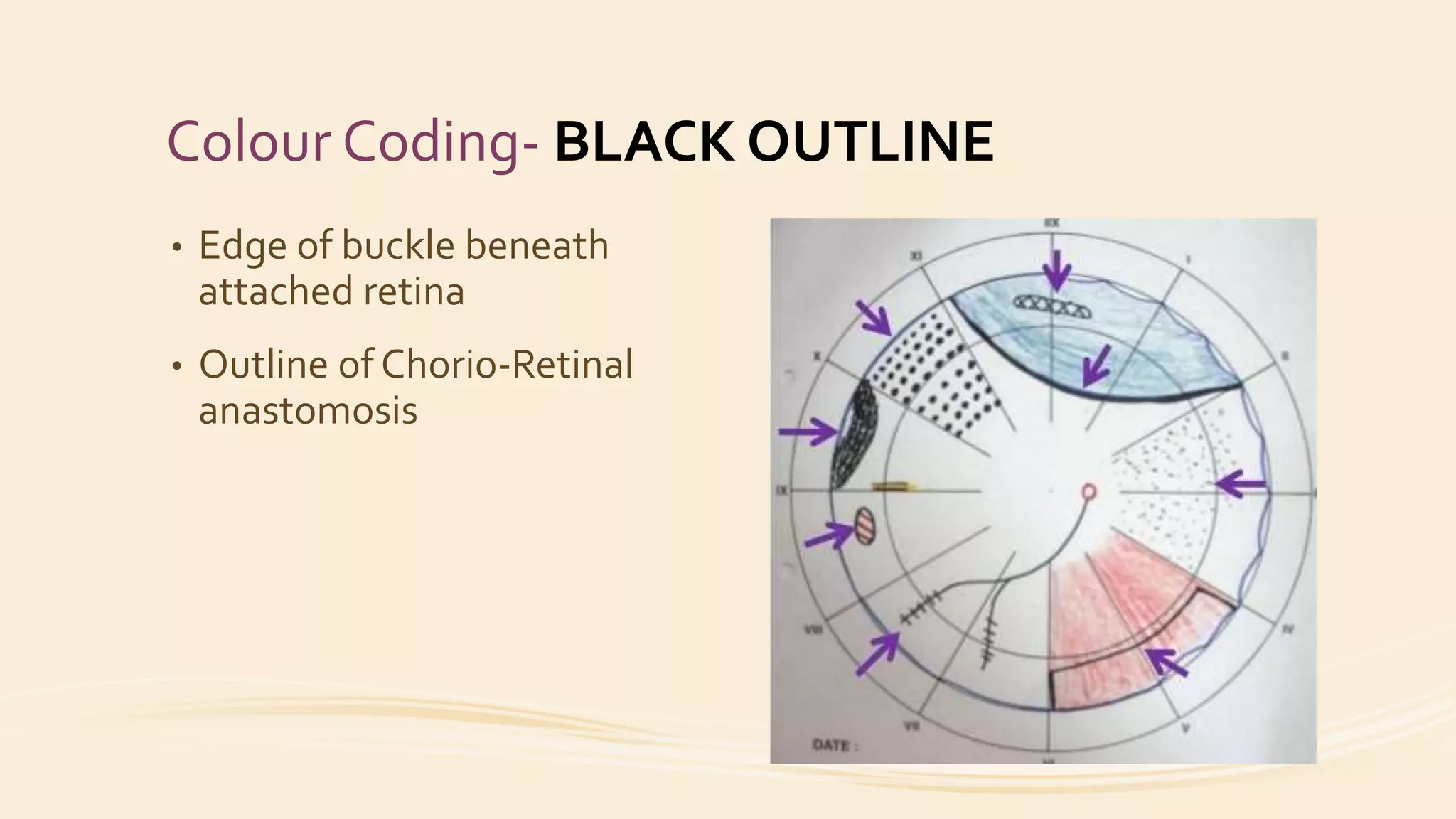 Direct & indirect ophthalmoscopy | PPTX