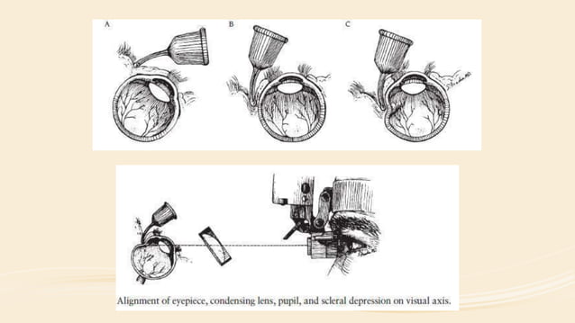 Direct & indirect ophthalmoscopy | PPTX | Eye and Vision Conditions ...