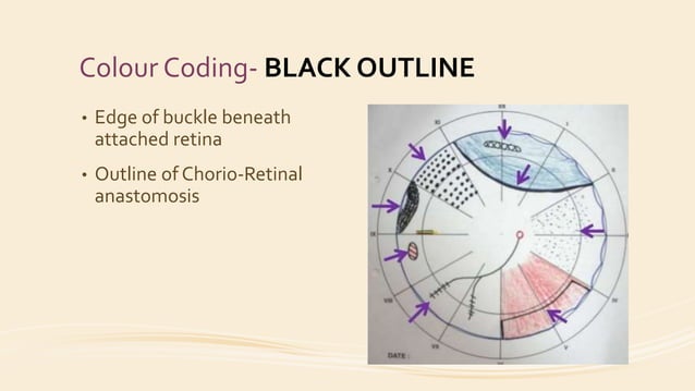Direct & indirect ophthalmoscopy | PPTX | Eye and Vision Conditions ...