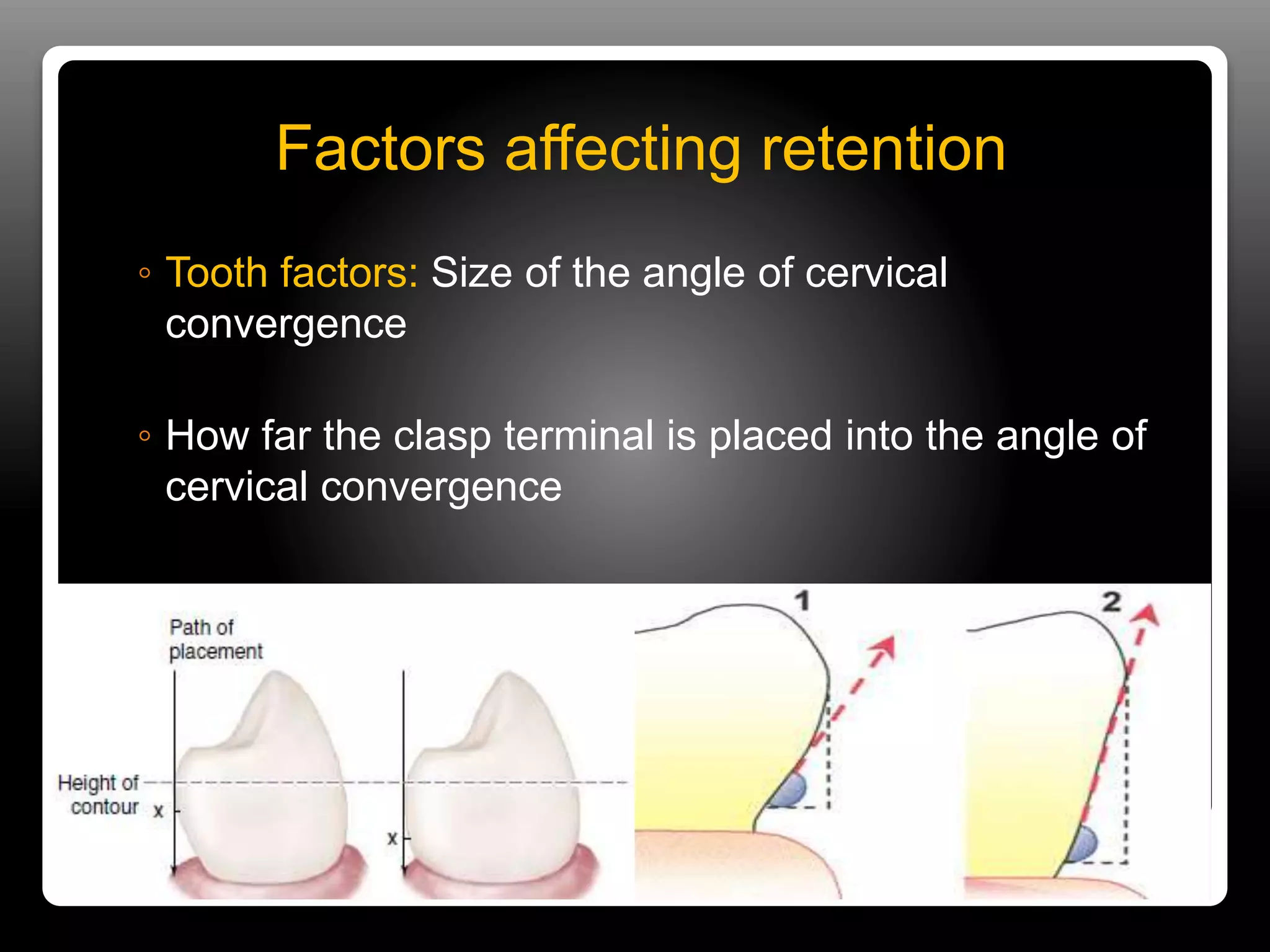 Direct & indirect retainers in rpd | PPTX