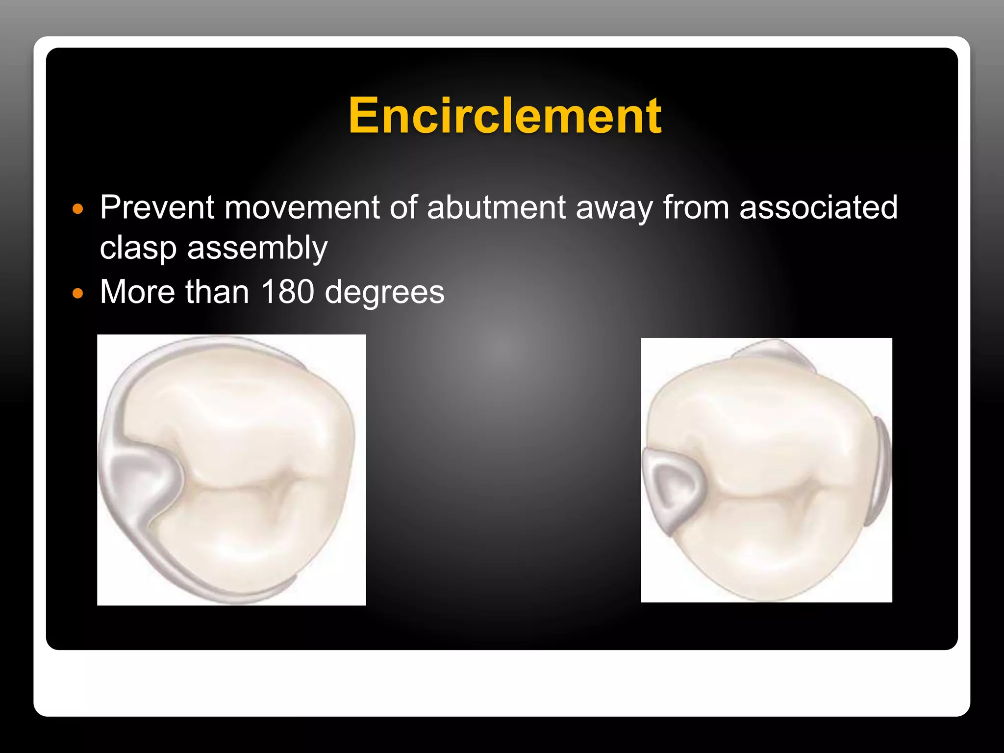 Direct & indirect retainers in rpd | PPTX