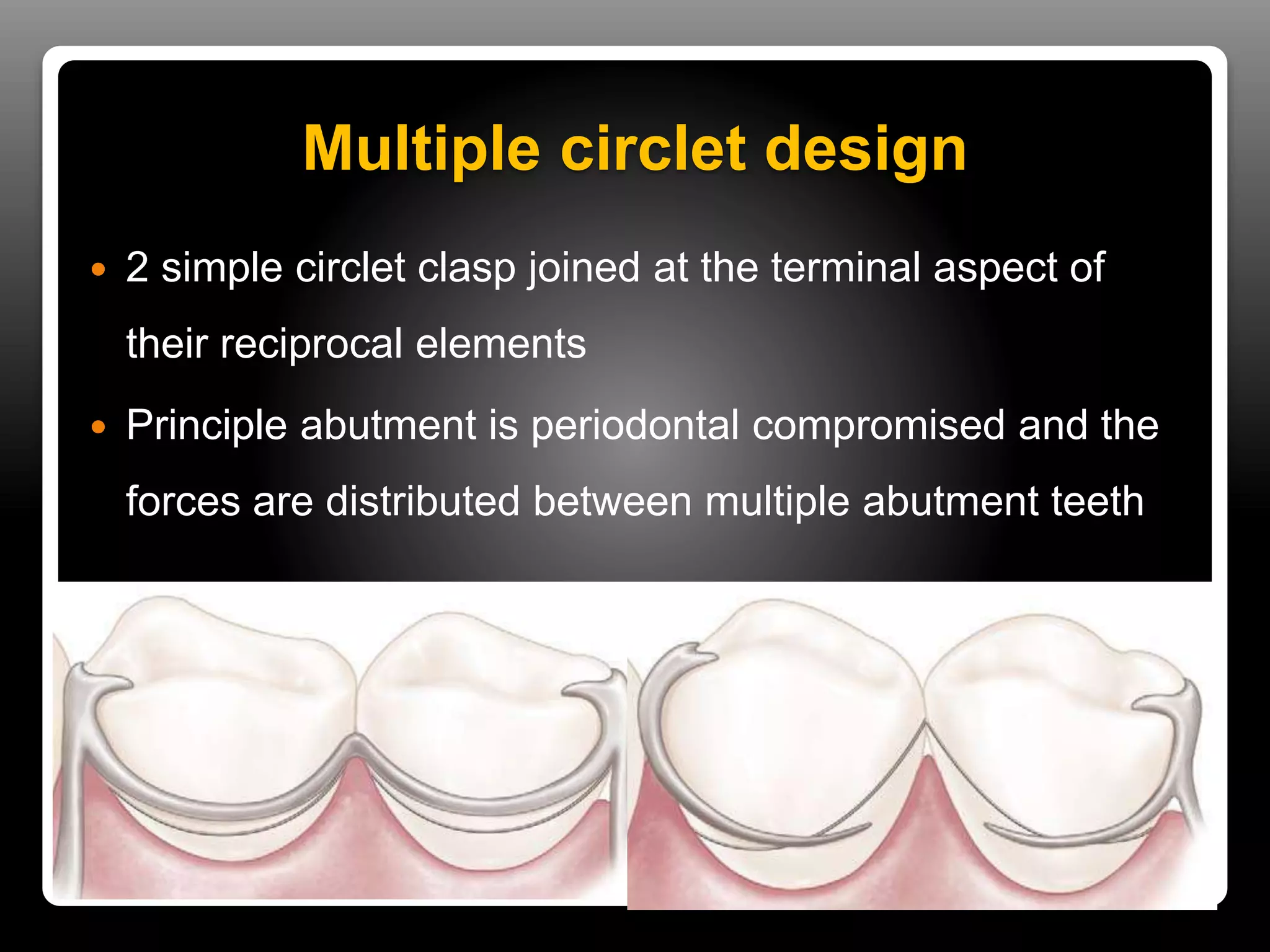 Direct & indirect retainers in rpd | PPTX