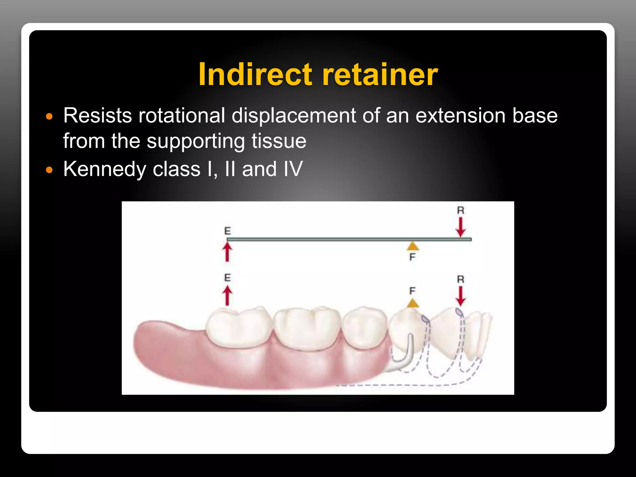 Direct & indirect retainers in rpd | PPTX