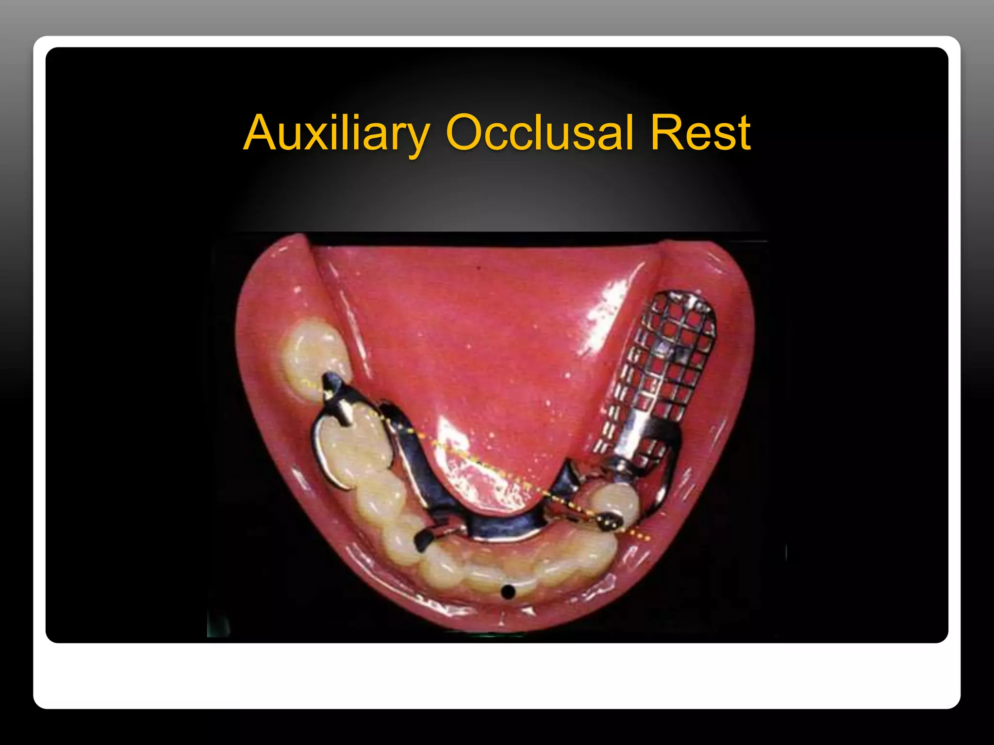 Direct & indirect retainers in rpd | PPTX
