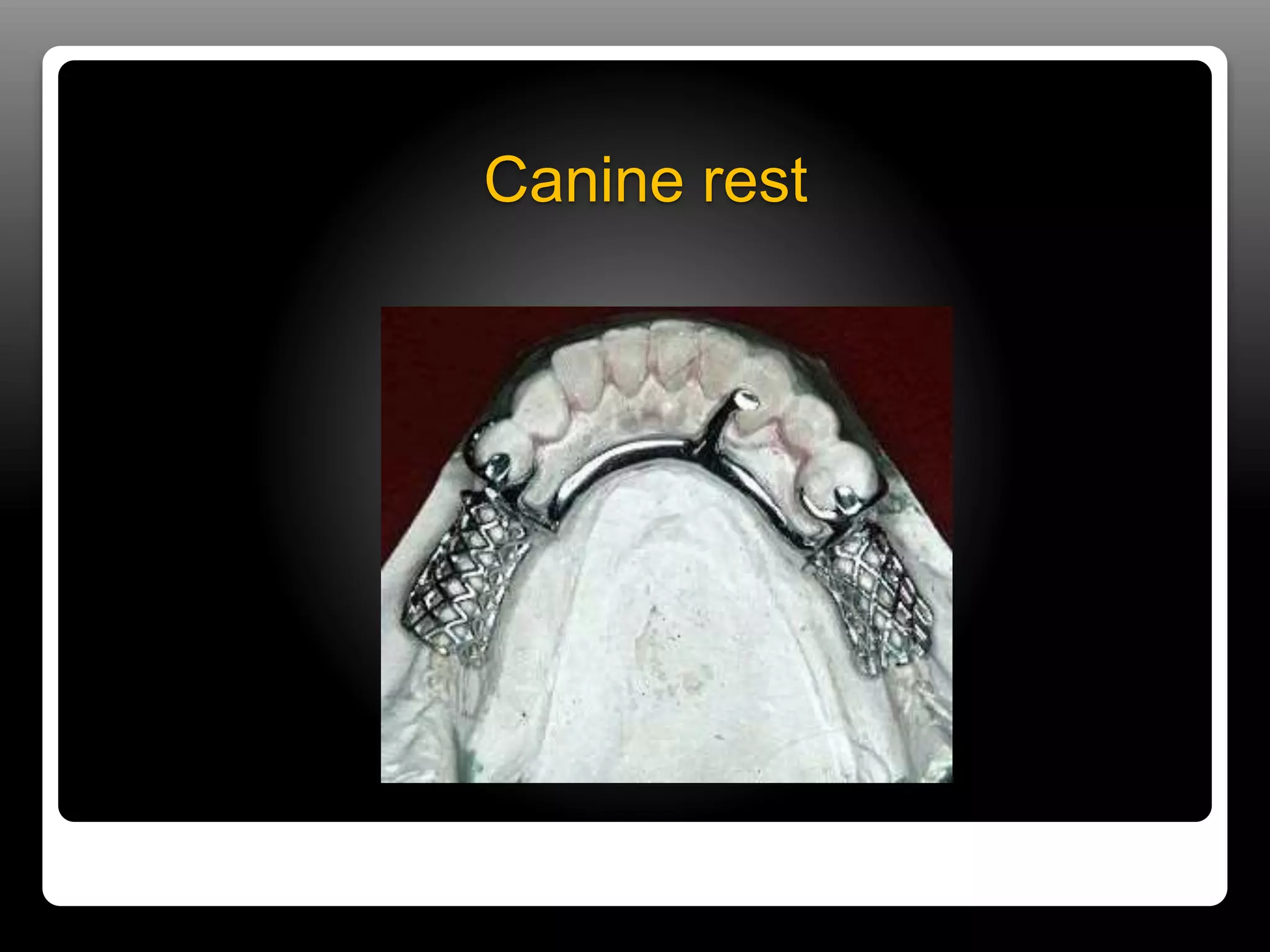 Direct & indirect retainers in rpd | PPTX