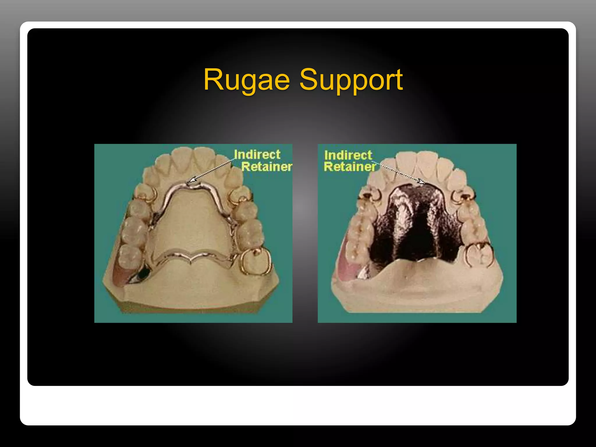 Direct & indirect retainers in rpd | PPTX