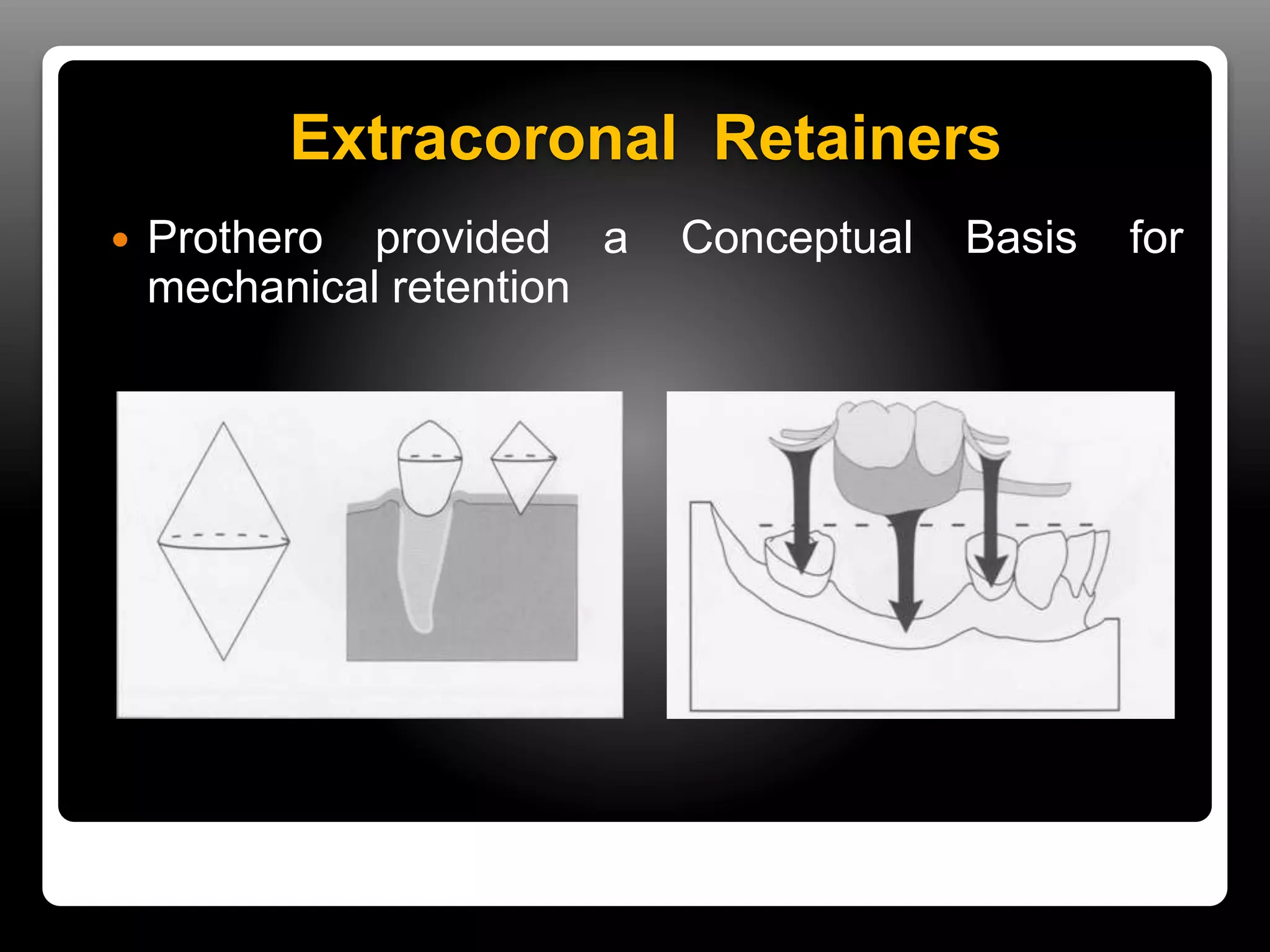 Direct & indirect retainers in rpd | PPTX