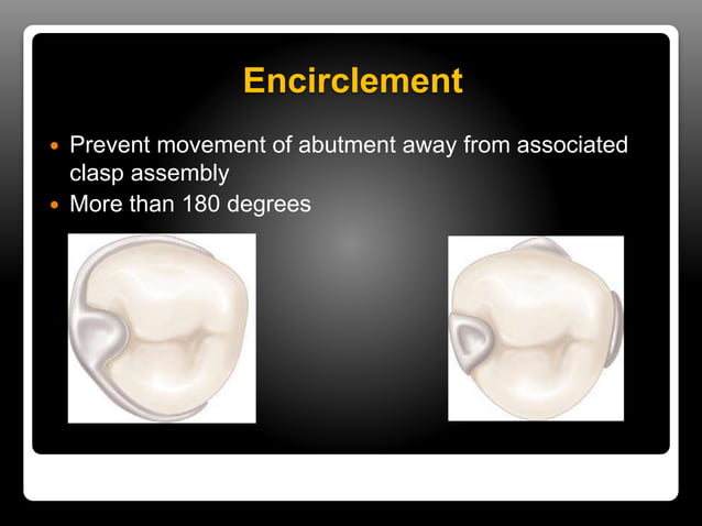 Direct & indirect retainers in rpd | PPTX