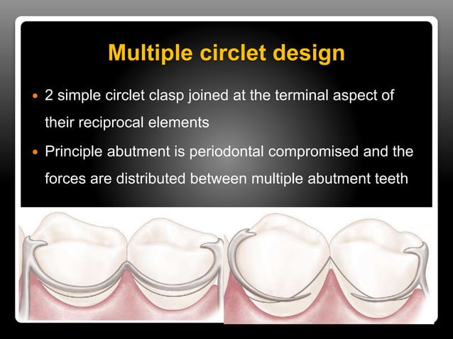 Direct & indirect retainers in rpd | PPTX