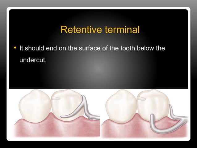 Direct & indirect retainers in rpd | PPTX