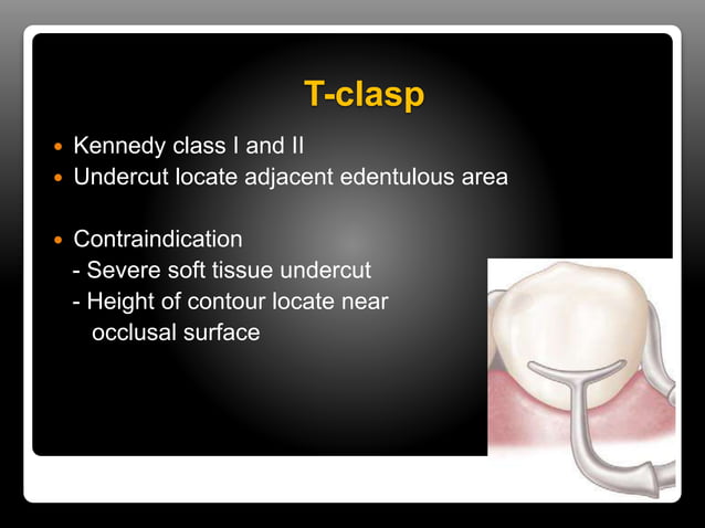 Direct & indirect retainers in rpd | PPTX
