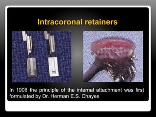 Direct & indirect retainers in rpd | PPTX