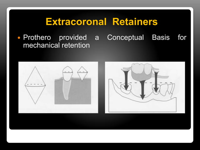 Direct & indirect retainers in rpd | PPTX