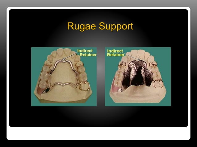 Direct & indirect retainers in rpd