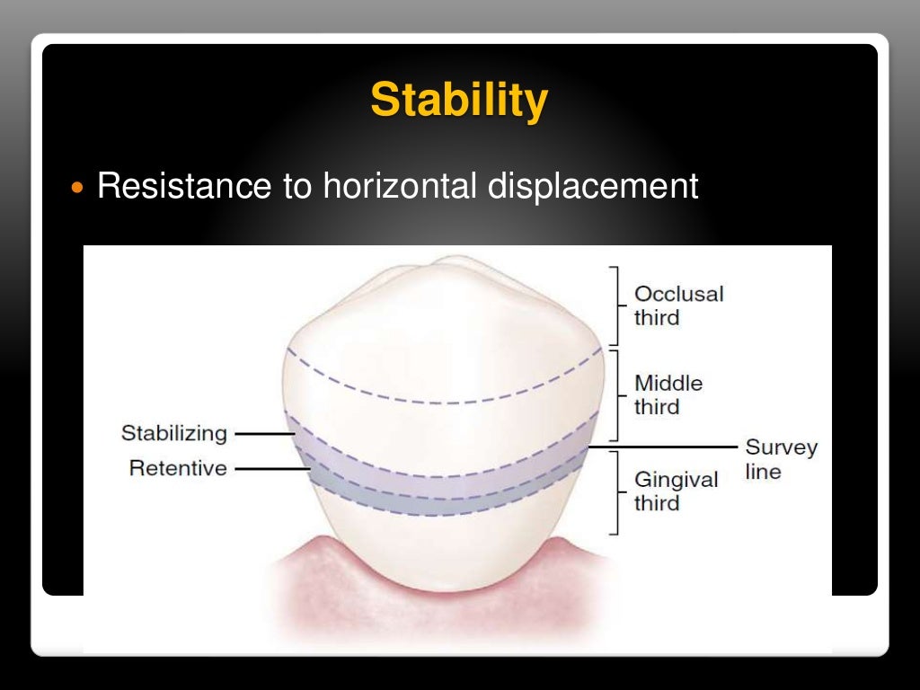 Direct & indirect retainers in rpd