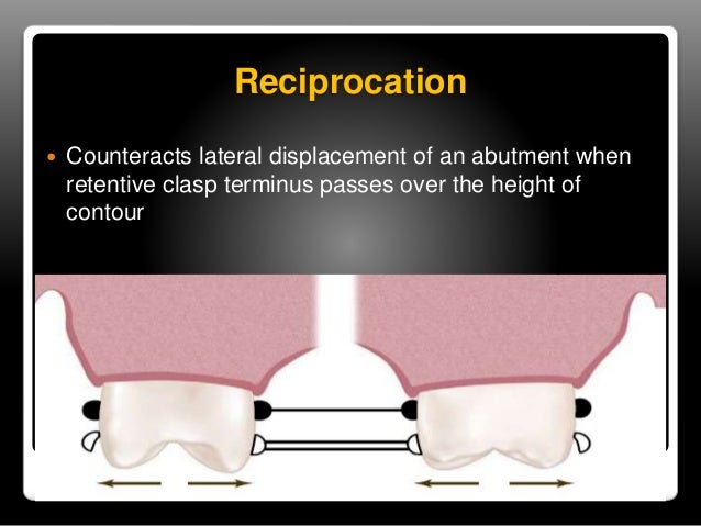 Direct & indirect retainers in rpd