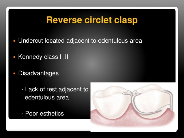 Direct & indirect retainers in rpd
