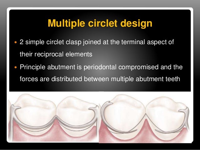 Direct & indirect retainers in rpd