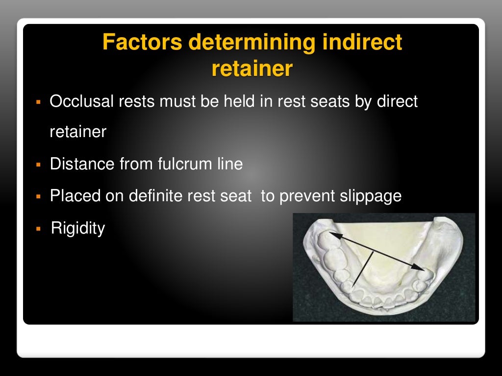 Direct & indirect retainers in rpd