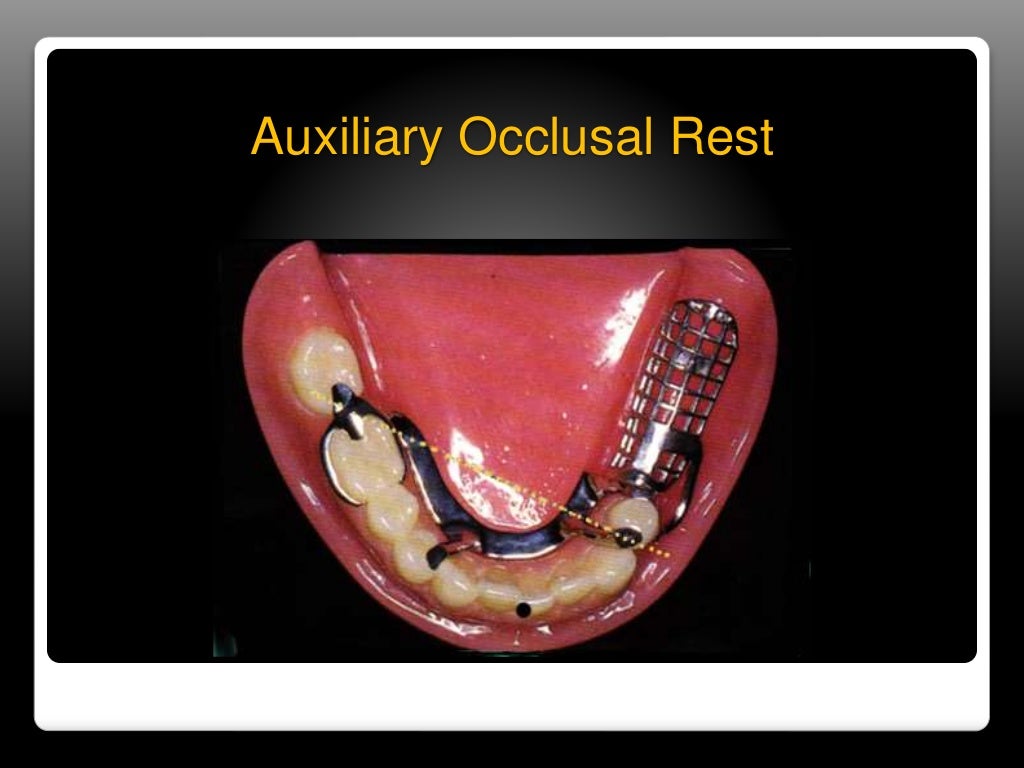 Direct & indirect retainers in rpd