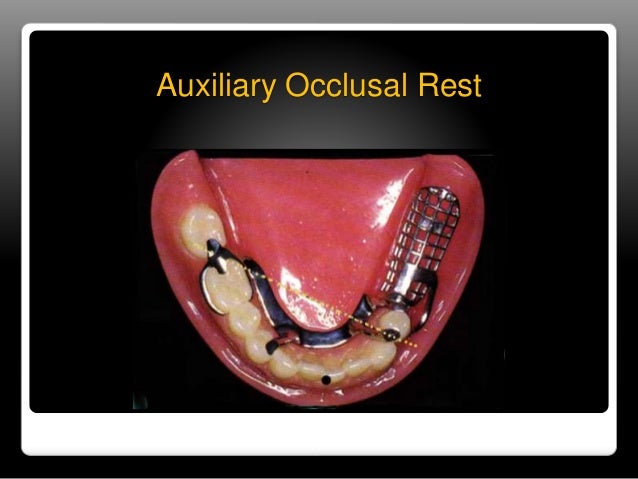 Direct & indirect retainers in rpd