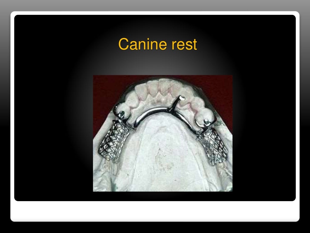 Direct & indirect retainers in rpd