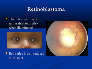 Direct & indirect ophthalmoscope | PPT