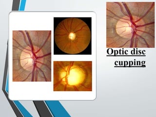 direct ophthalmoscope NMU.pptx