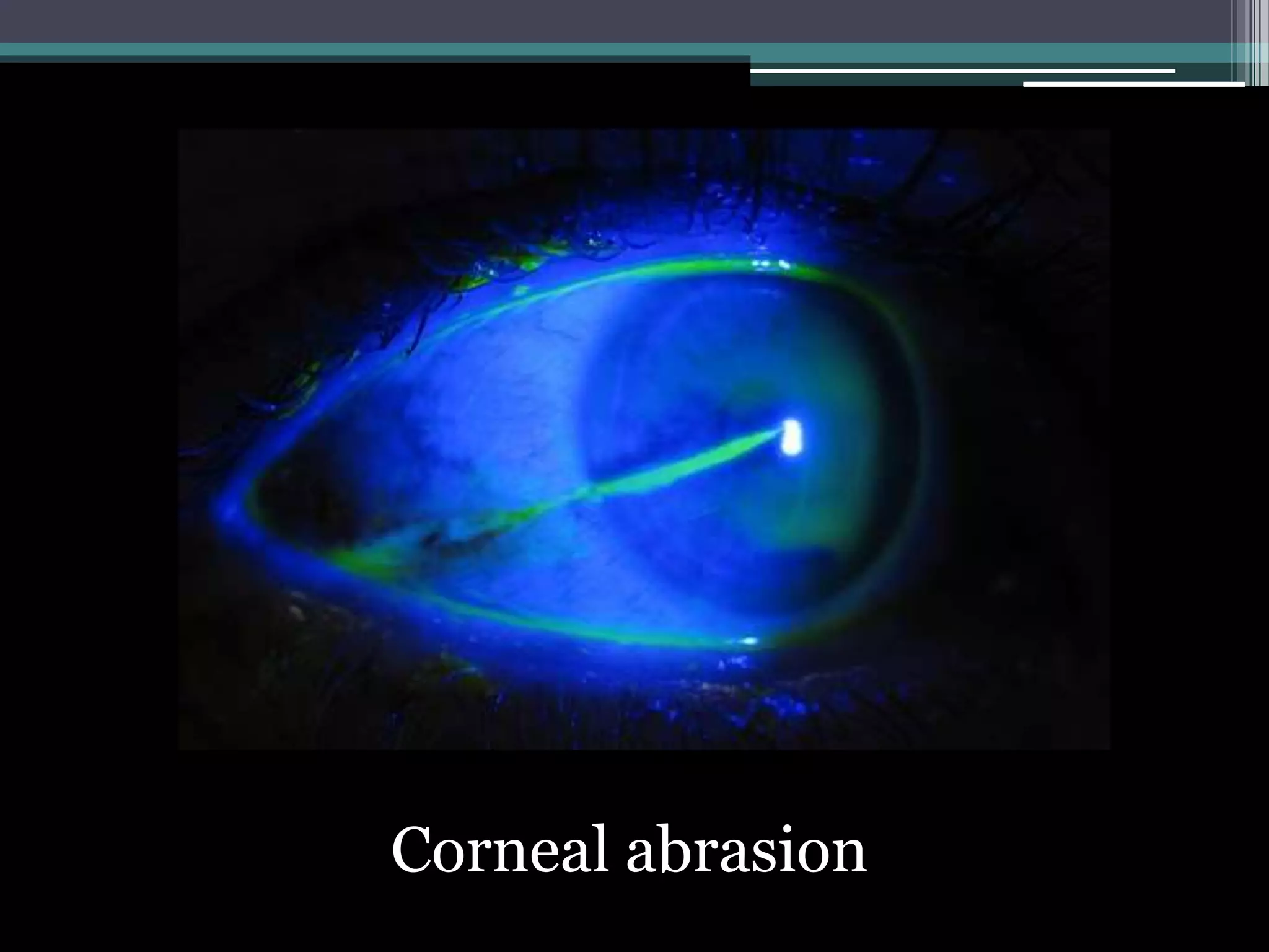 Direct Ophthalmoscopy/Fundoscopy | PPTX