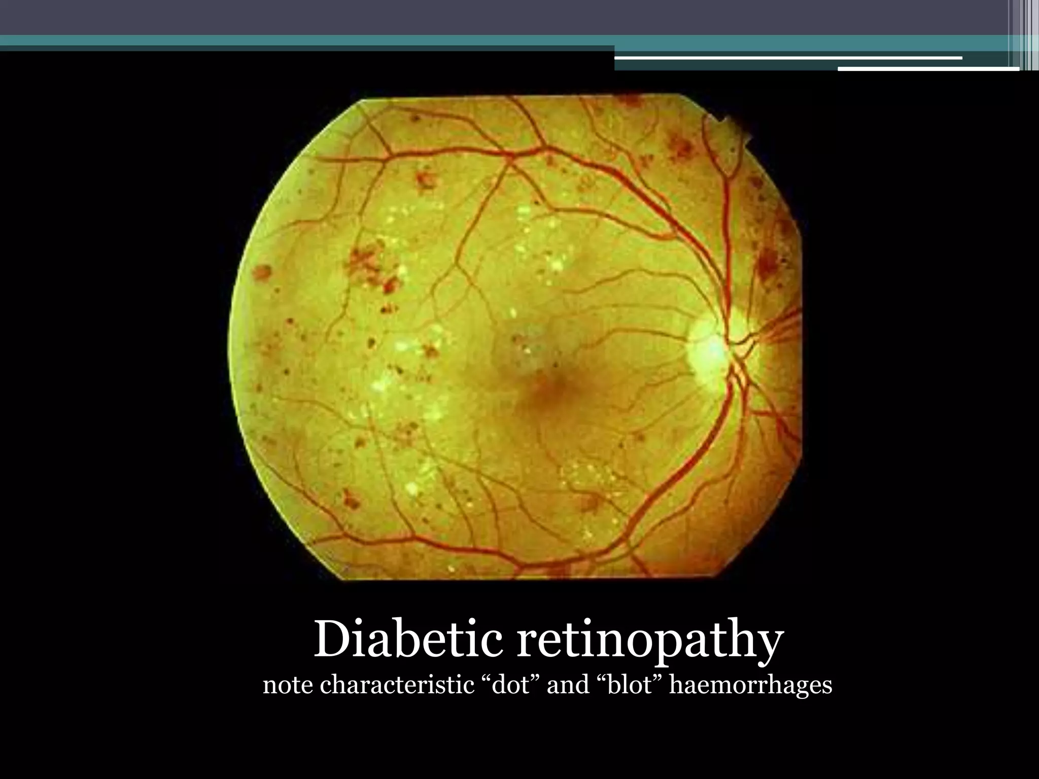 Direct Ophthalmoscopy/Fundoscopy | PPTX