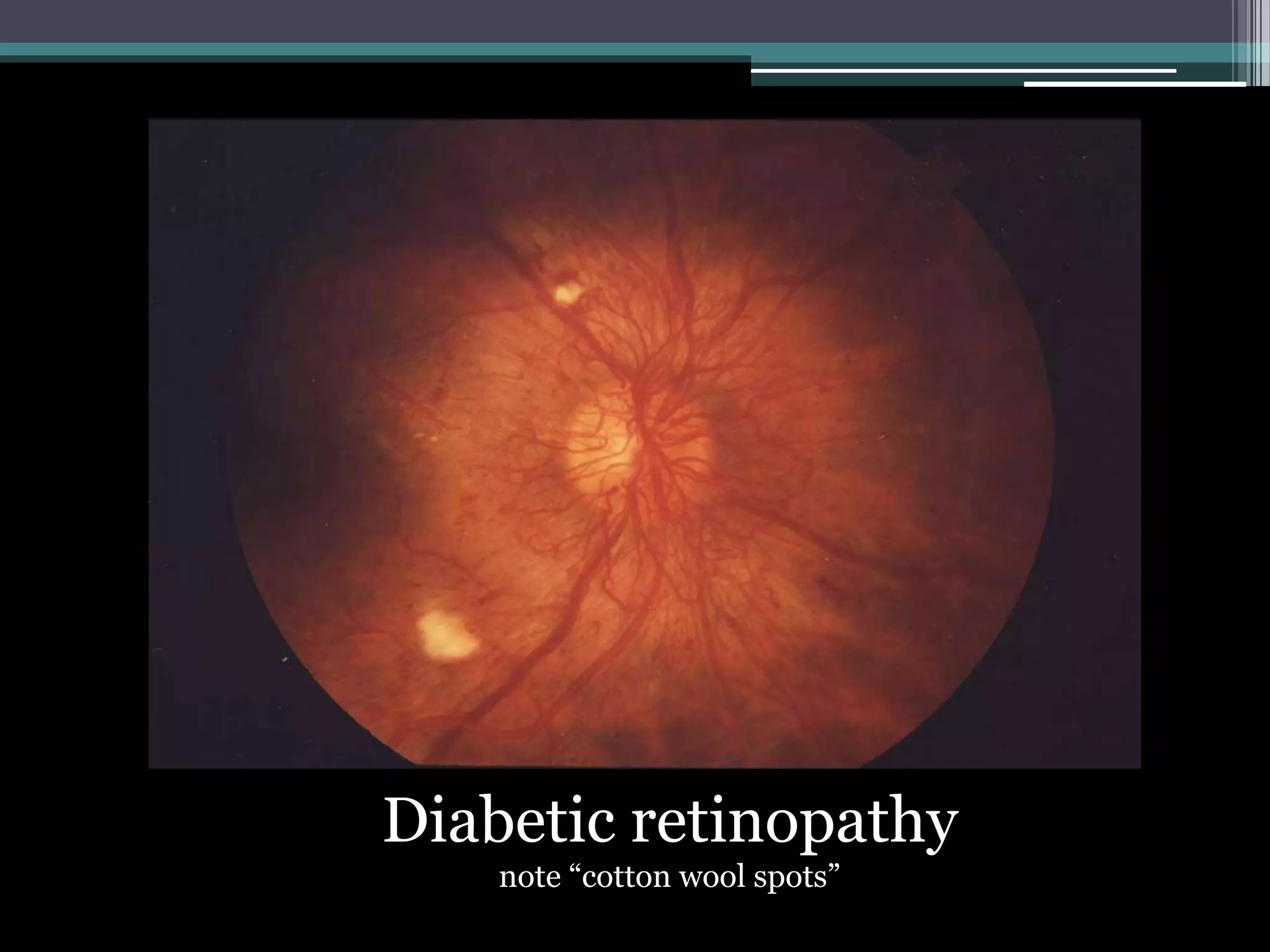 Direct Ophthalmoscopy/Fundoscopy | PPTX