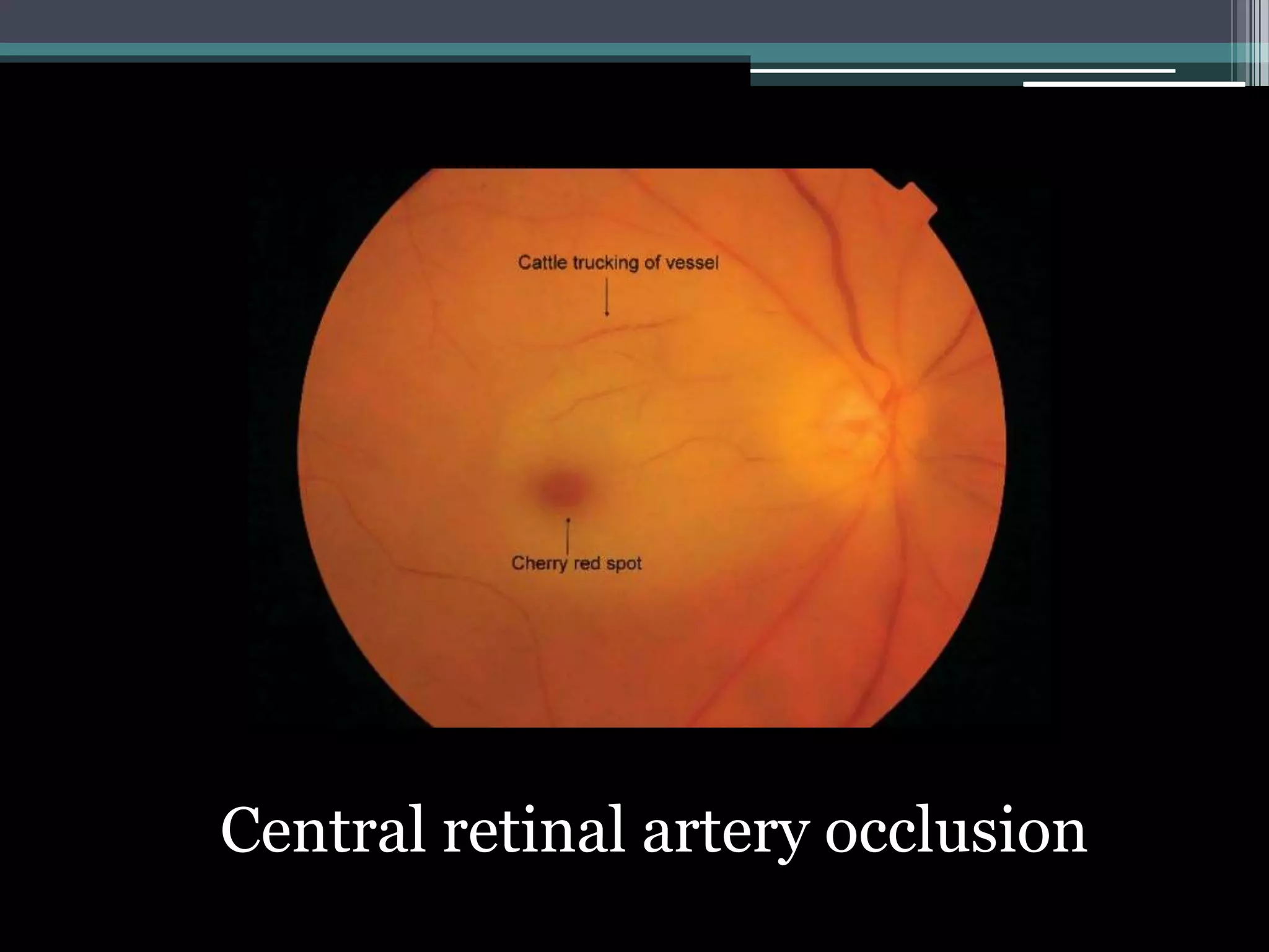 Direct Ophthalmoscopy/Fundoscopy | PPTX